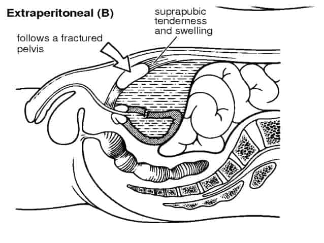 RUPTURE BLADDER - New