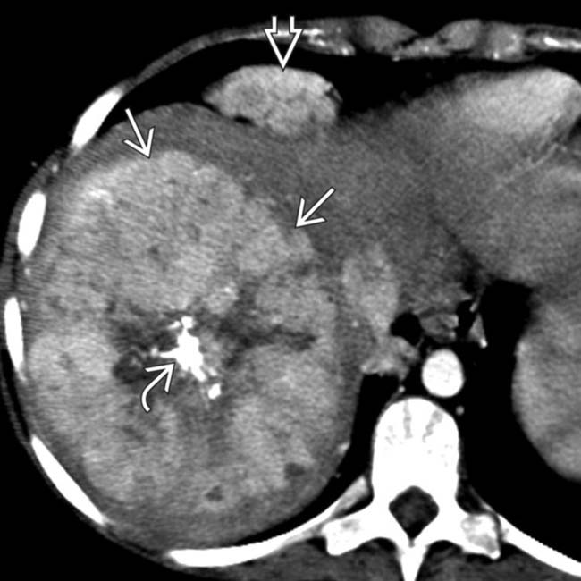 FIBROLAMELLAR CARCINOMA - New