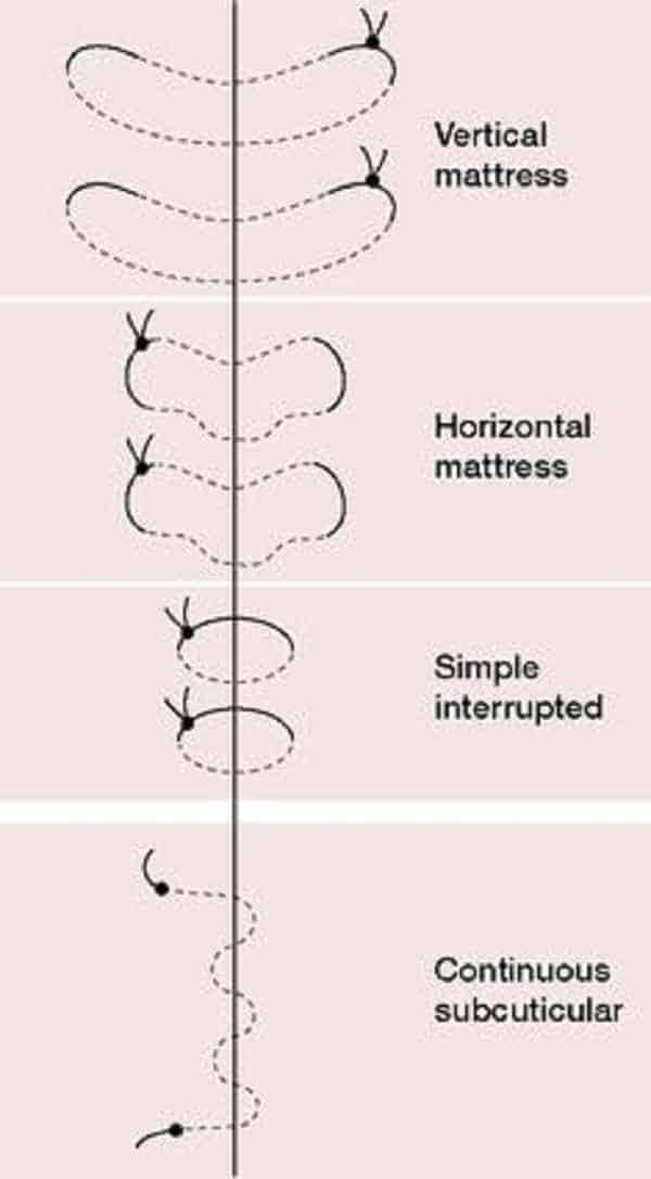 Suture and Suture Materials - www.medicoapps.org