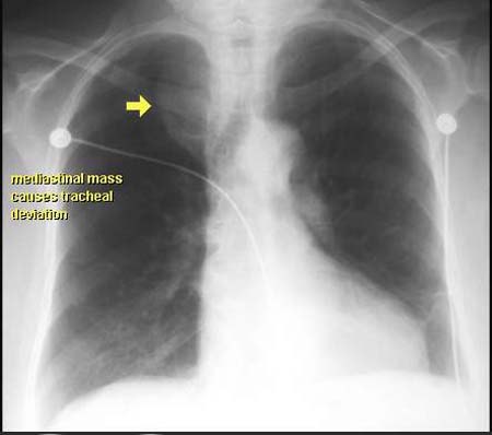 RETROSTERNAL GOITER - New