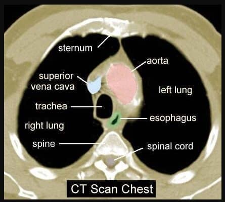 CT chest - www.medicoapps.org