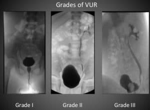 grades of vesicoureteral reflux - New