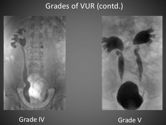 grades of vesicoureteral reflux(4 & 5) - www.medicoapps.org