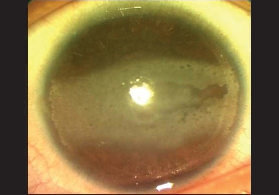 Band-shaped-keratopathy-obscuring-the-visual-axis-with-no-view-of-pupil ...