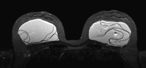 linguine sign mri - New
