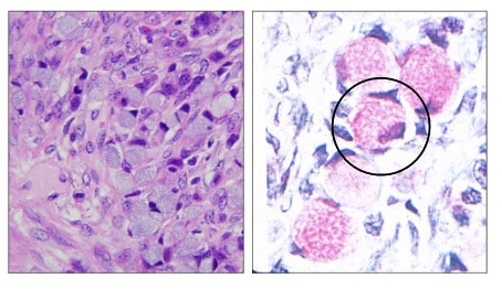 signet ring cells - New