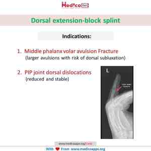 Dorsal Extension Block Splint Slide3 - New